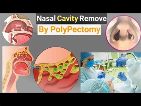 Polyp Removal Specialist In Singapore Sjis