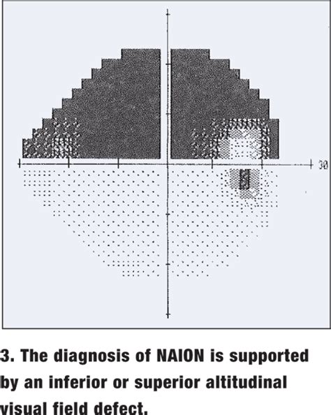 Sudden Vision Loss Simplified Approach Epomedicine