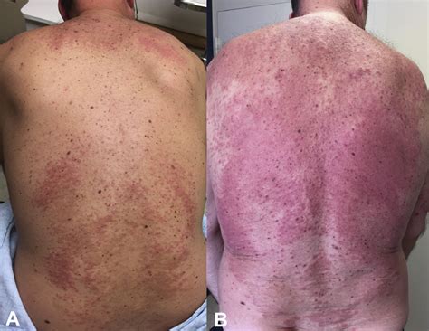 Severe Recalcitrant Morbilliform Eruption From Dual Immune Checkpoint