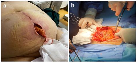 Complete Abdominal Evisceration After Open Hysterectomy A Case Report