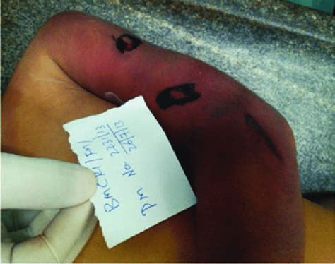 Contusion And Abrasion Over Left Upper Limb Download Scientific Diagram