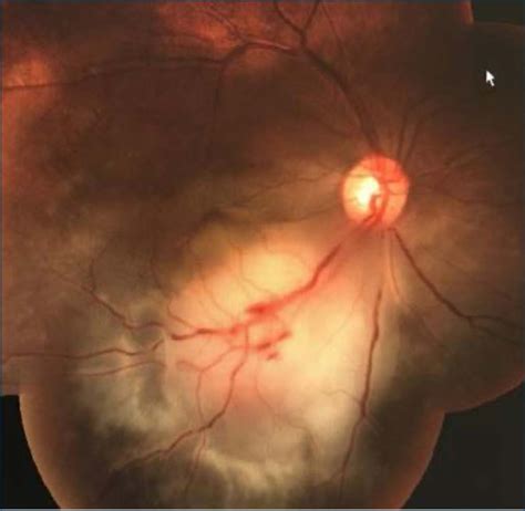 Choroidal Tubercles