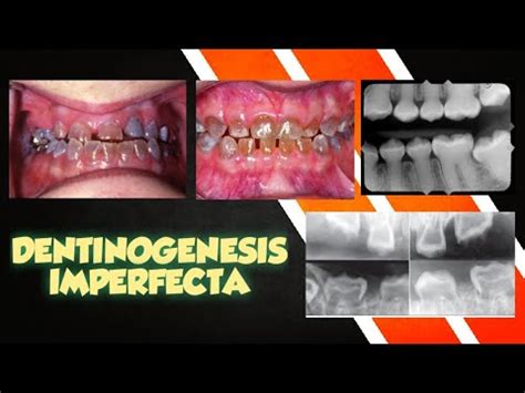 Developmental Anamolies Of Teeth Dentinogenesis Imperfecta Youtube