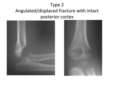 Classificaton Of Injuries Around Elbow Management Of Supracondylar