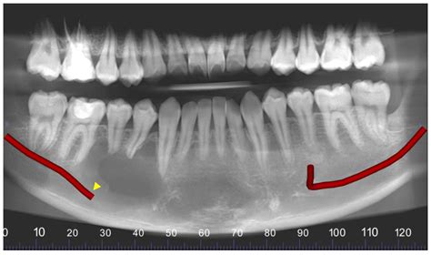 Mural Unicystic Ameloblastoma Of The Mandible A Case Report