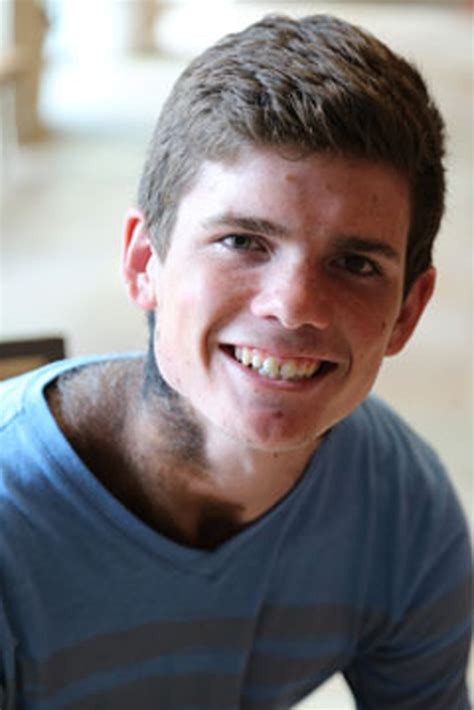 Nevus Congenital Melanocytic Nevus Positive Exposure