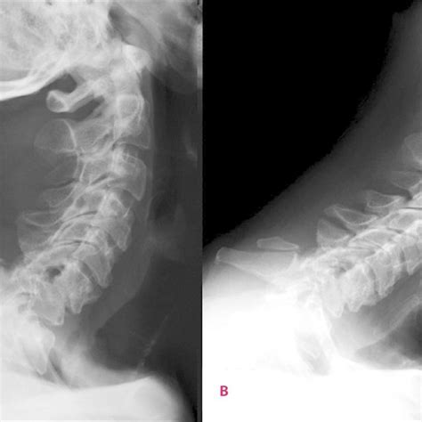 Ct Imaging A Sagittal View Of Bilateral Facet Dislocation With Bony Download Scientific