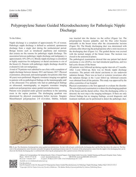 Pdf Polypropylene Suture Guided Microdochectomy For Pathologic Nipple