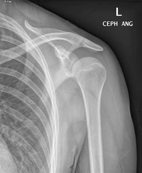 Lunate Dislocation And Radial Styloid Fracture Artofit