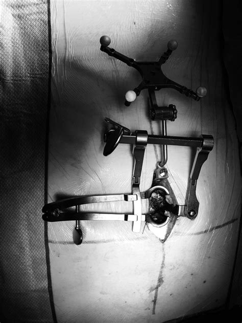 Raed Abusuwwa On Linkedin An Approach To Calcified Thoracic Disc In Morbidly Obese Patients