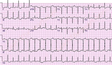 Wolff Parkinson White Alternans Wpw Alternans Ecg