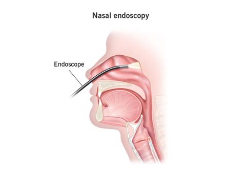 آندوسکوپی سینوس بیمارستان مرتاض یزد