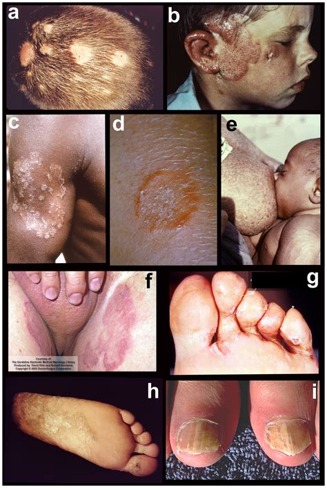 Tineas Throughout The Body Tineas Are Dermatophyte Infections Of The