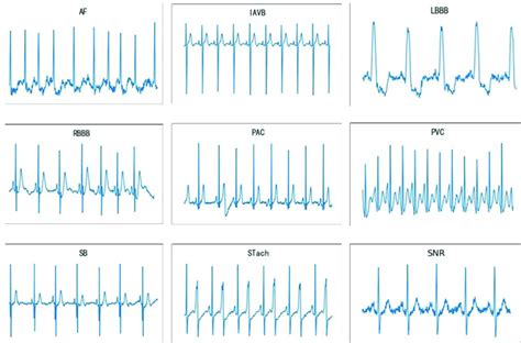 samples of each class of ecg download scientific diagram