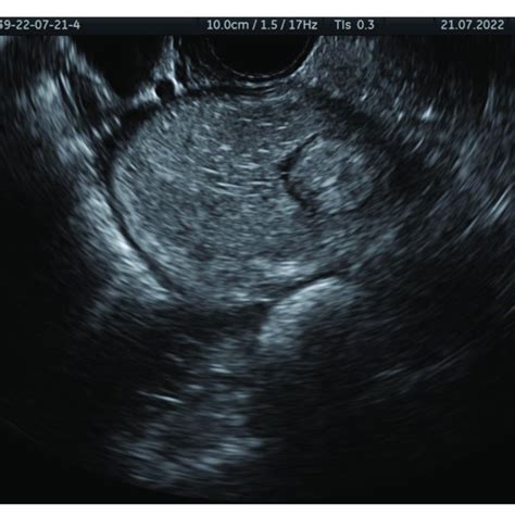 Transvaginal Ultrasound Of A Mature Teratoma Echogenic Foci Or