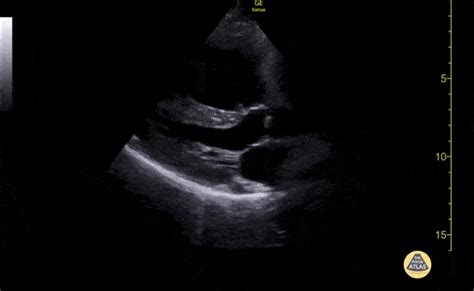 Right Ventricular Dysfunction — Tpa