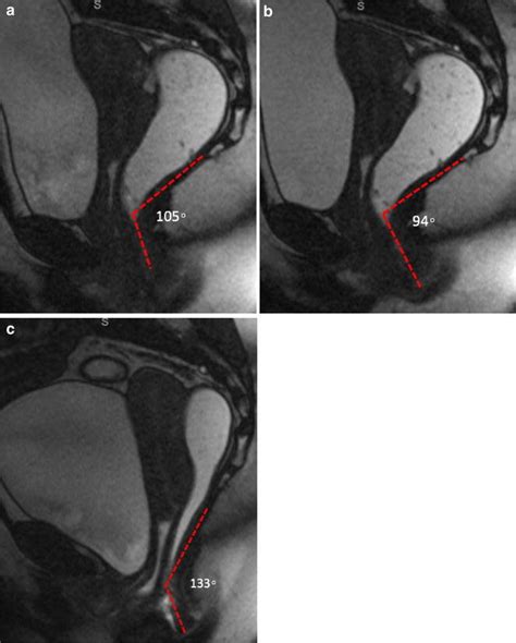 Anorectal Angle T2 Weighted Midsagittal Mr Image Of A Female Pelvis