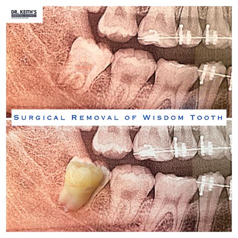 ️ Oral Surgery Odontectomy Dr Keiths Dental Clinic