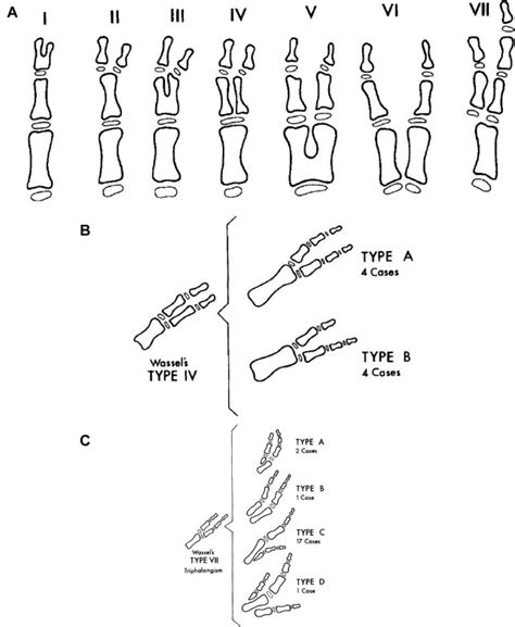Treatment Of Common Congenital Hand Conditions Clinics In Plastic Surgery