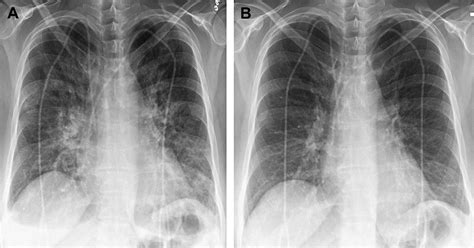 Imaging Of Complications Of Hematopoietic Stem Cell Transplantation