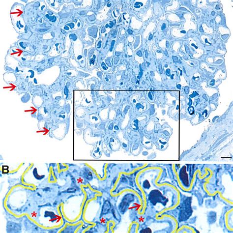 Diffuse Mesangial Sclerosis Dms A Overview Of An Entire Tuft