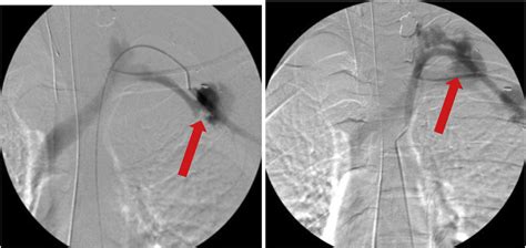 Ct Angiography Chest A Large Rapidly Expanding Hematoma Creating An