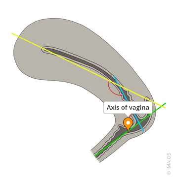 Axis Of Vagina E Anatomy Imaios