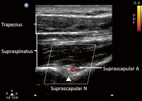 Ultrasound Pain Block Tip Of The Week Suprascapular Nerve Block Nysora