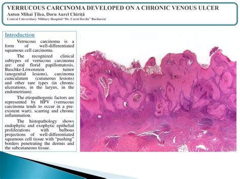 Ppt Introduction Verrucous Carcinoma Is A Form Of Well Differentiated