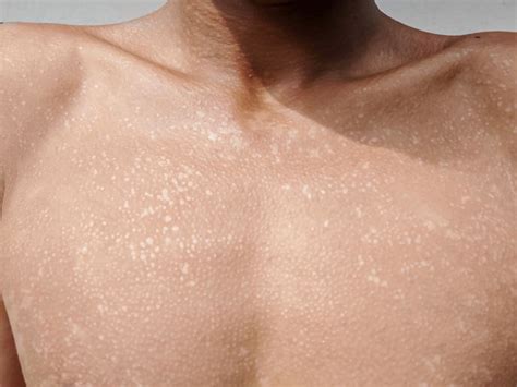 White Bumps On Chest Male
