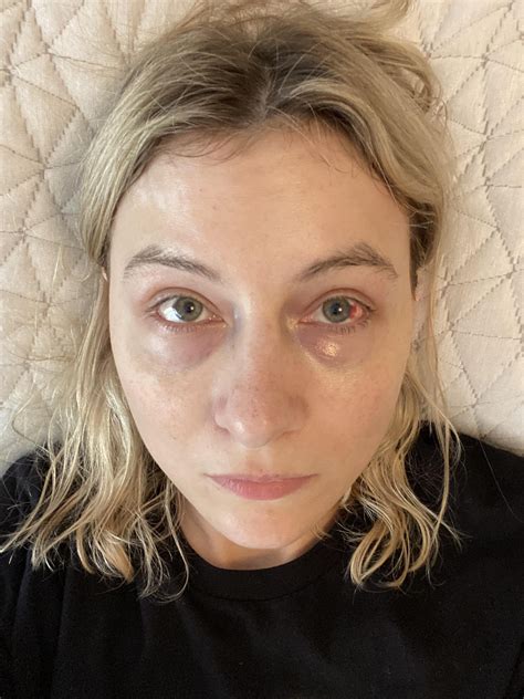 One Month Of Healing After Double Strabismus Surgery Its Now One Year