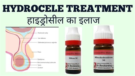 Hydrocele Treatment In Homeopathy