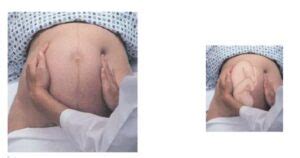 4 Key Steps Of The Leopold Maneuver For Accurate Fetal Positioning