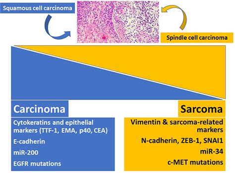 Approaches To Tumor Classification In Pulmonary Sarcomatoid Carcinoma