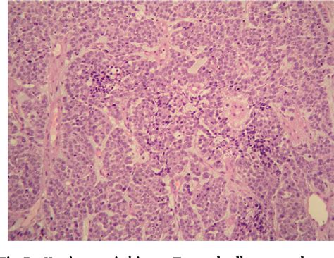 Figure 1 From Serpiginous Choroiditis In A Patient With Uterine Cervix