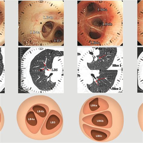 Bronchoscopy Ct Image And Navigation Mapping Of The Right Lung