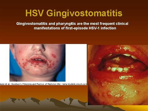 Common Viral Infections Herpes Virus Infections The Objectives