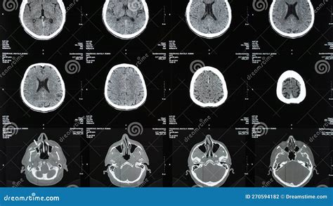 Mri Of The Brain Of An Old Man Editorial Photography Image Of Clinical Neurology 270594182