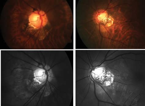 Tackling The “myopia Or Glaucoma” Question