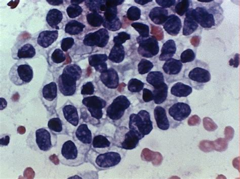 Ontario Shifts From Pap To Hpv Test For Cervical Cancer Screening Toronto Sun