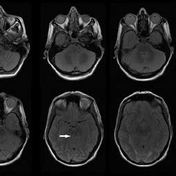 PDF Diagnostic Efficacy Of Conventional MRI Pulse Sequences In The