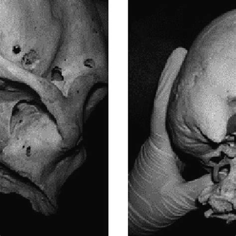 A And B Lateral View Showing The Styloid Process Length 46 5mm Download Scientific Diagram