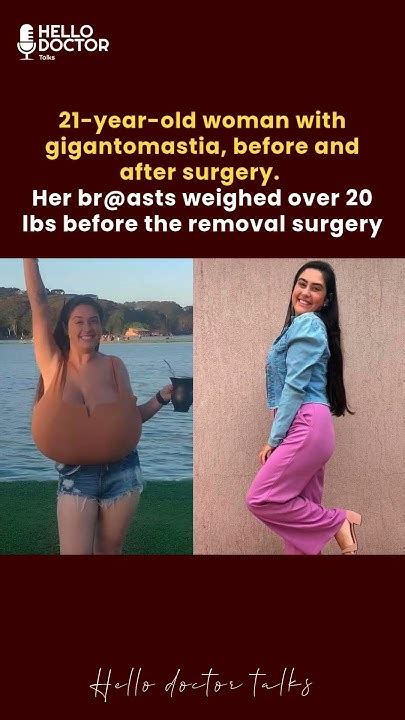21 Year Old Woman With Gigantomastia Before And After Surgery
