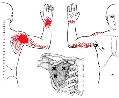 Trigger Point Therapy