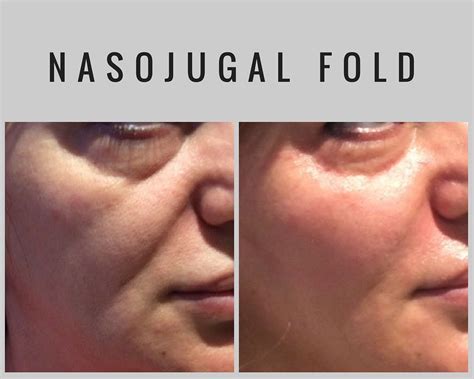 Drml Skin Clinic Make Over Monday • • What Is A Nasojugal Fold Its