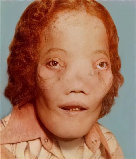 History Rocky Dennis Was Born In 1961 With Craniodiaphyseal Dysplasia