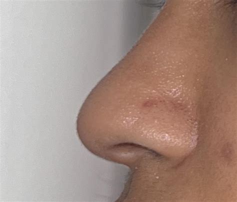 Nose Piercing Scar Preventing And Treating Body Piercing Scars