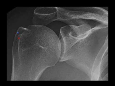 Shoulder Imaging Shoulder And Elbow Orthobullets