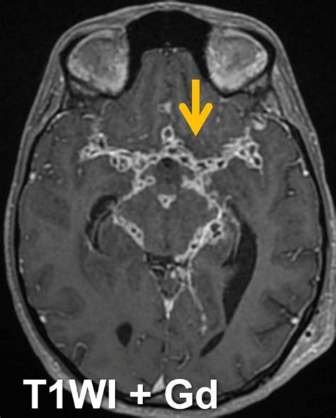 Classic Case American Journal Of Neuroradiology