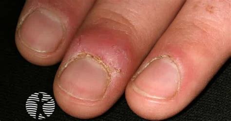 Mycobacterium Marinum Image